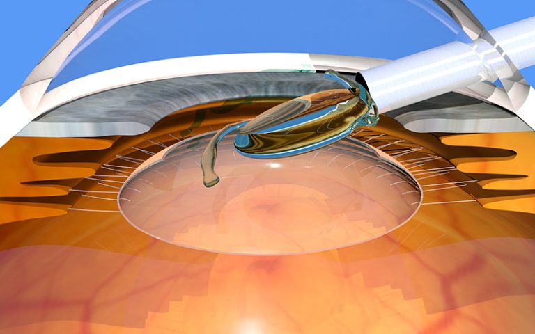 Cirugía de Cataratas en Ibagué, Tolima, Colombia